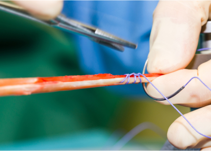 ACL Reconstruction | Knee Surgeon | Van Nuys, Westlake Village, Los ...