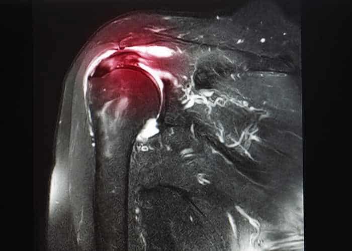 Superior Capsular Reconstruction | Rotator Cuff Tear | Van Nuys ...