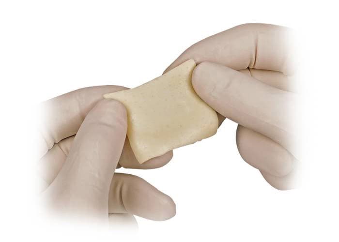 Dermal Matrix Allograft | Rotator Cuff Surgeon | Van Nuys, Westlake ...